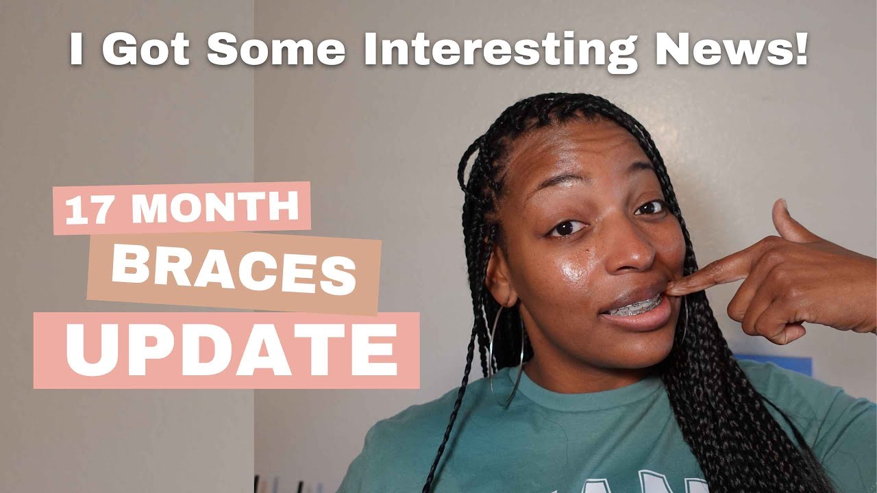 17 Month Braces Update | My Orthodontist Gave Me Some Interesting News ...