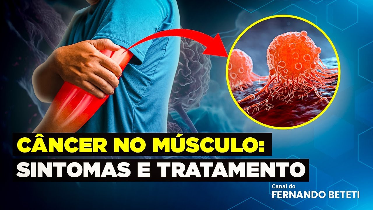 CÂNCER NO MÚSCULO: SINTOMAS E TRATAMENTO | DR. BENY SCHMIDT - FERNANDO ...