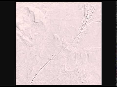 AAA BiLobed - YouTube