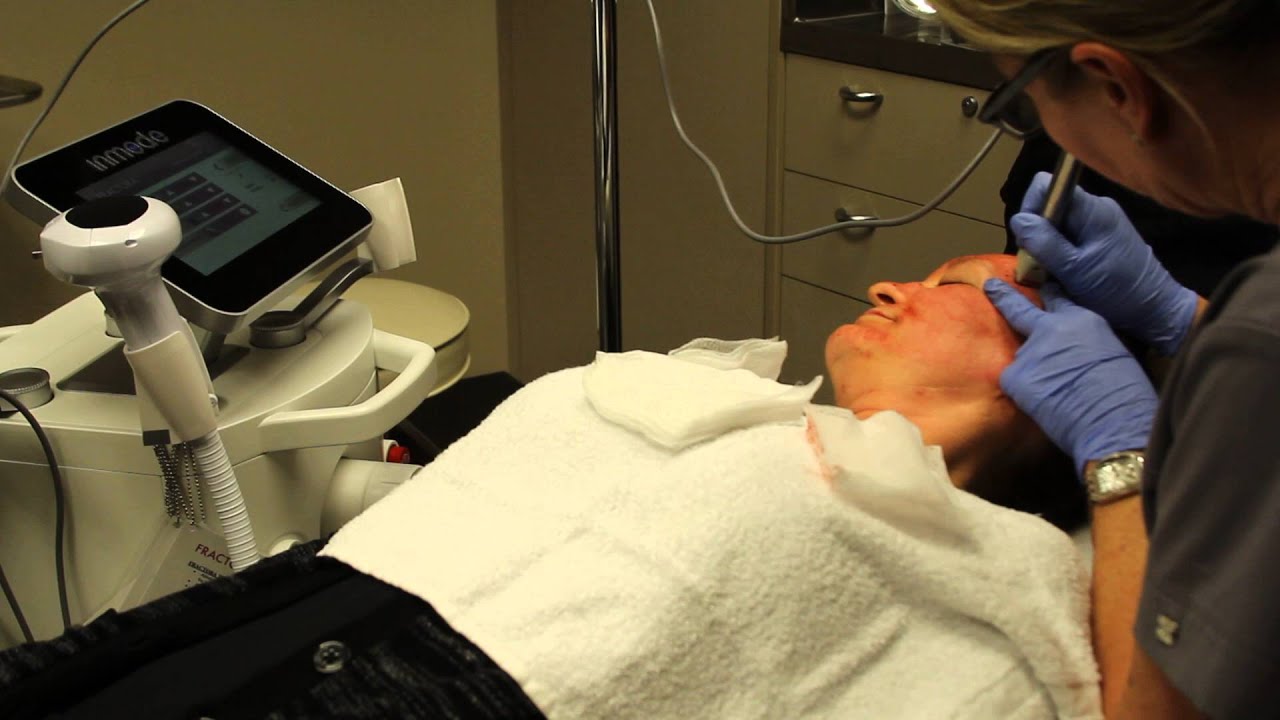 Fractora RF Facial Rejuvenation Treatment - YouTube