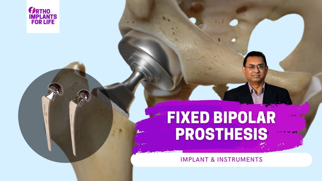 Fixed Bipolar Prosthesis | Implants & Instruments - YouTube