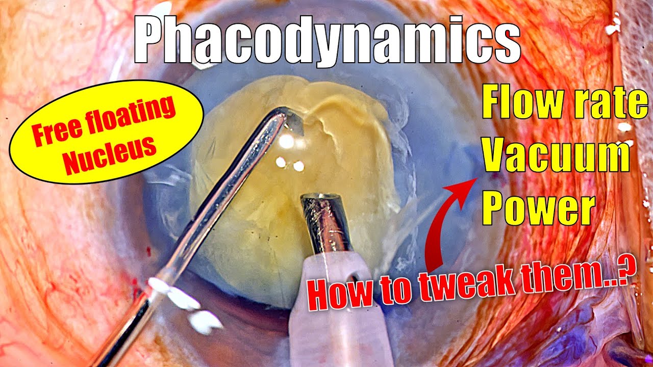 Phaco Basics- Phaco Parameters. How to tweak them to our advantage ...
