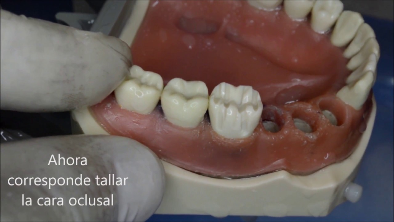 Tallado molar 46 parte 1 de 2017 - YouTube