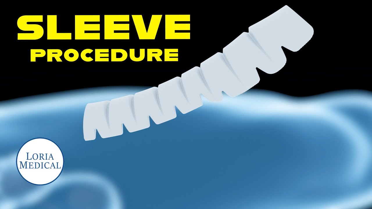 Loria Medical SLEEVE procedure, how it's done. - YouTube