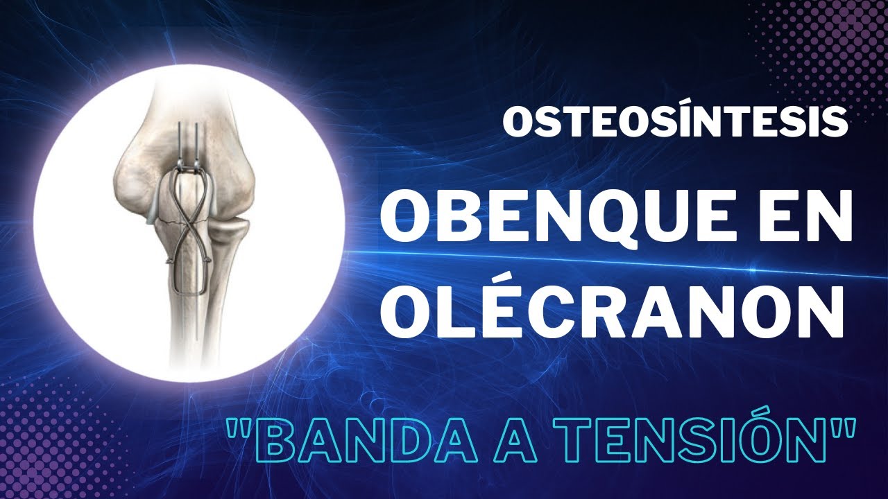 Osteosíntesis - Obenque en olécranon "Banda a tensión" - YouTube