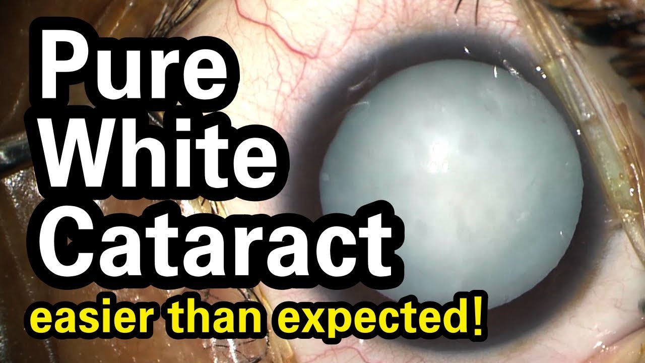 pure white cataract - it's easier than expected!, just follow some ...