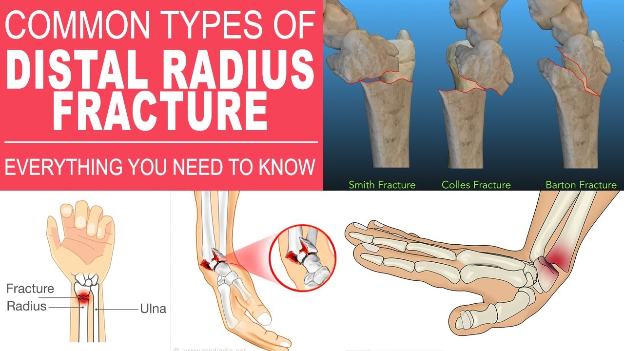 Common Types Of Distal Radius Fractures - Everything You Need To Know ...