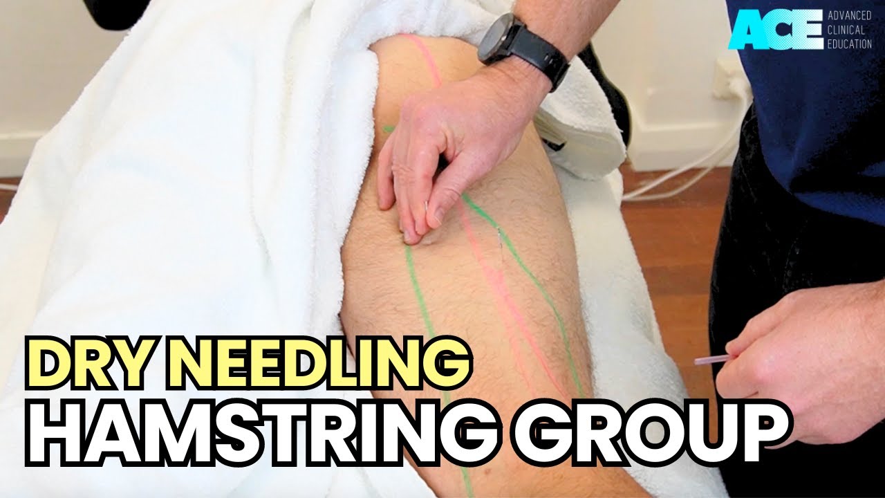 Dry Needling: Hamstring Group - YouTube