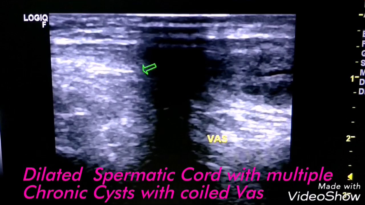 Bilateral Chronic Epididmo Orchitis with Vasitis - YouTube