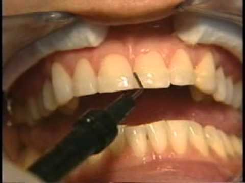 Emergency Trauma Splint - YouTube