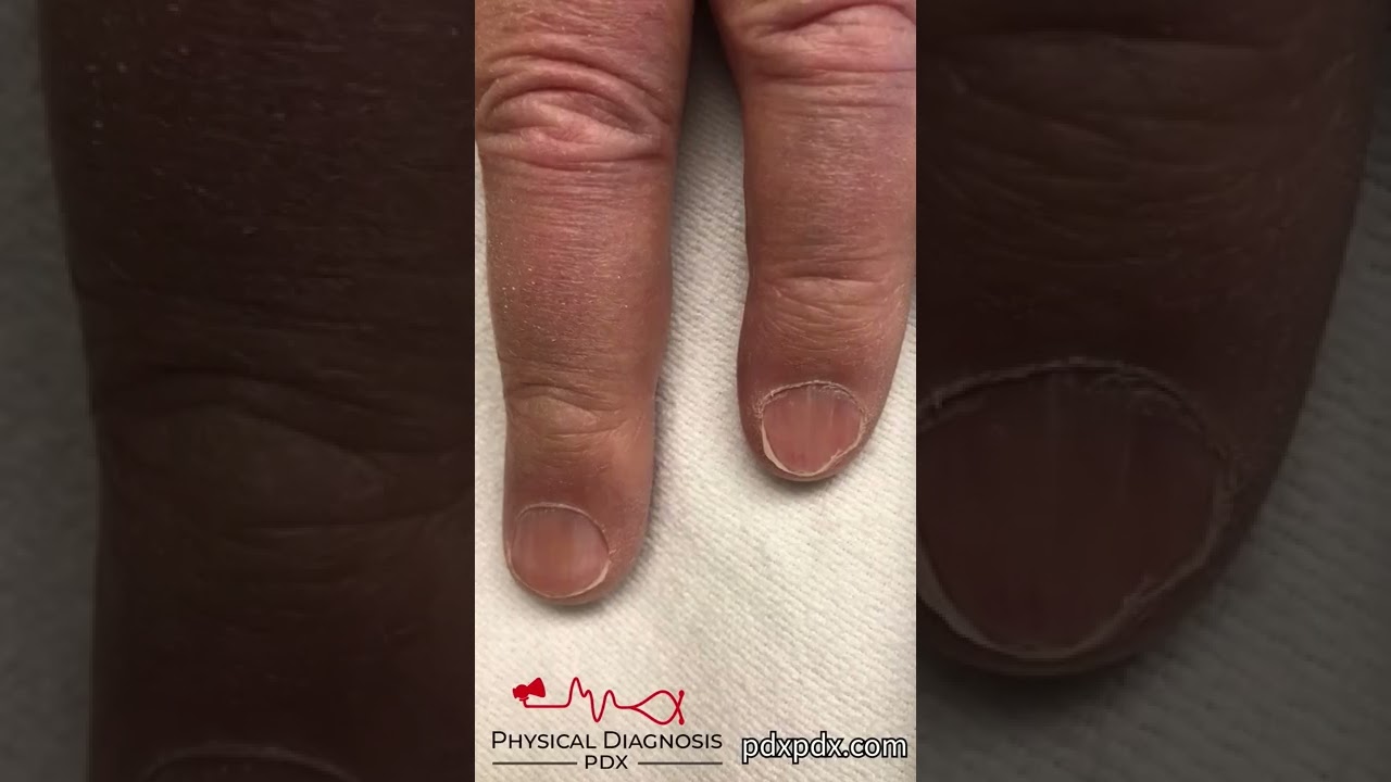 Quincke's Pulse in severe #hyperdynamic_circulation - YouTube