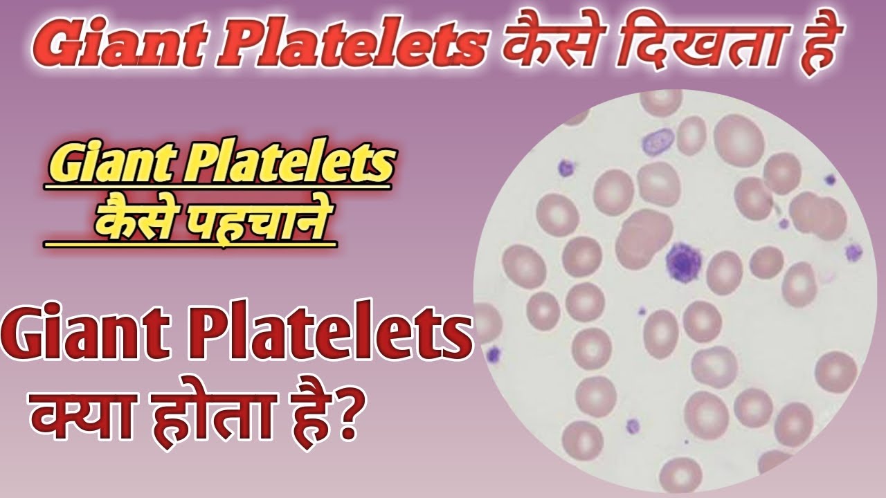 Rare Giant Platelets
