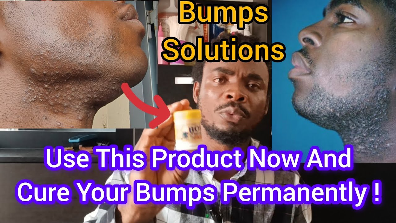 Use This Product Now And Cure Your Bumps Permanently: Bumps Causes ...