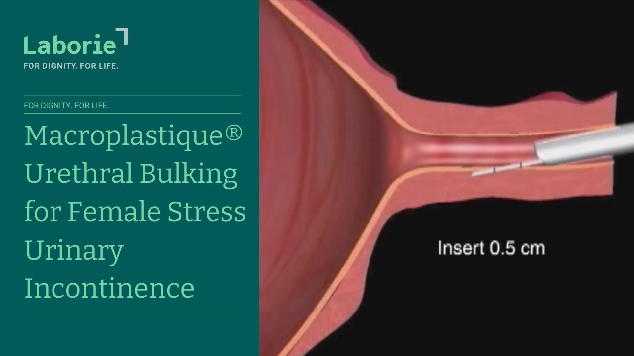 Macroplastique® Urethral Bulking for Female Stress Urinary Incontinence ...