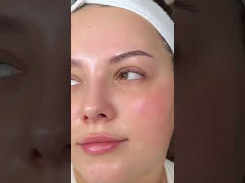 Augenringe Behandlung Wien | Augenringe entfernen, Augen falten ...