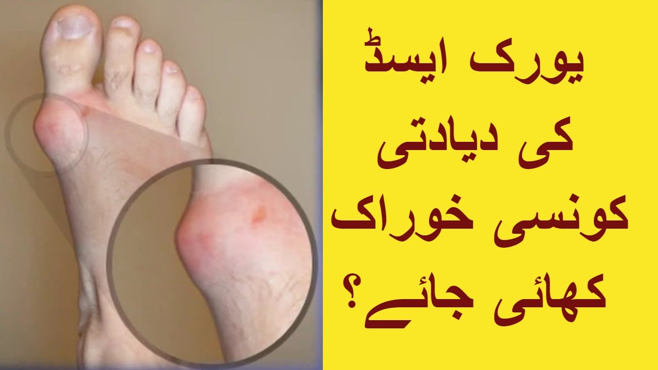 What is Hyperuricemia? || What is Dietary Advice for High Blood Uric ...