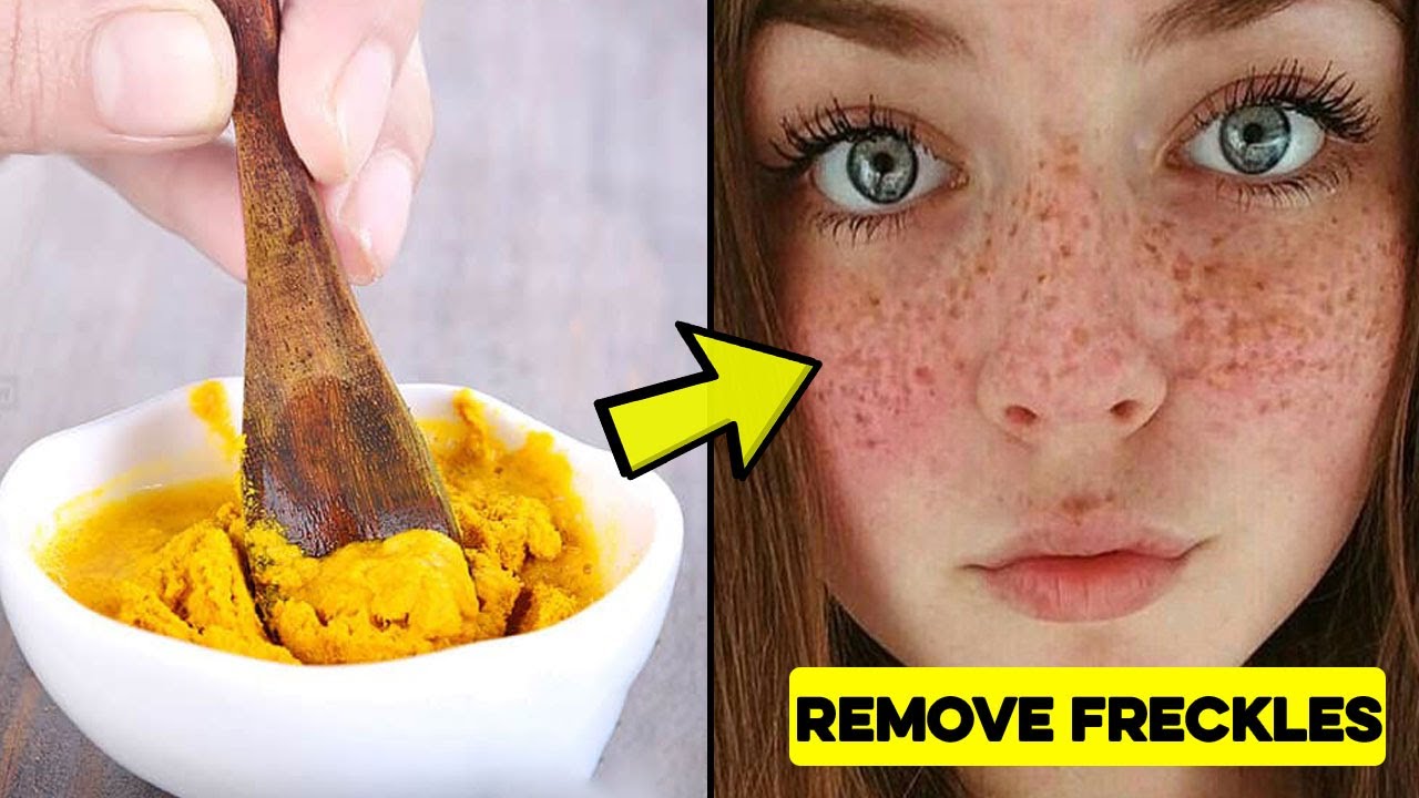 How to Get Rid of Freckles on Your Face at Home | 3 Home Remedies to ...