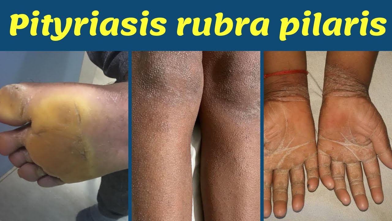 Pityriasis rubra pilaris /Thick palm,sole cause & treatment / पाँव,हाथ ...