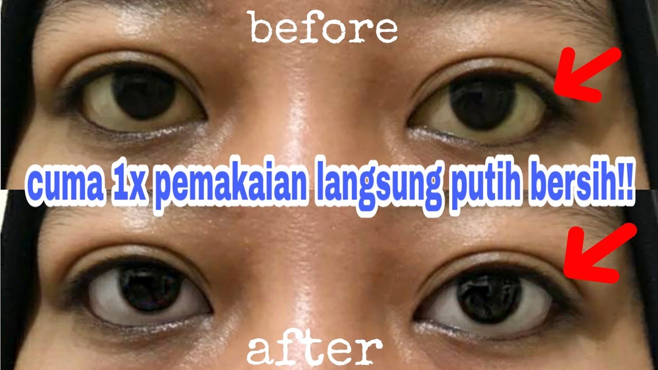 CUMA 12.000 BISA MEMUTIHKAN MATA KUNING, MENGOBATI RABUN, DAN ...