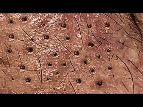 Blackhead Removal With Sac Dep Spa @100074219 - YouTube
