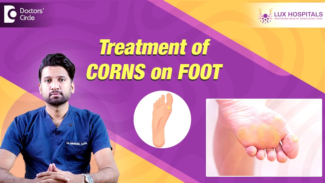 Foot corn removal | Deep corn on bottom of foot | Corn Cap| Corn ...
