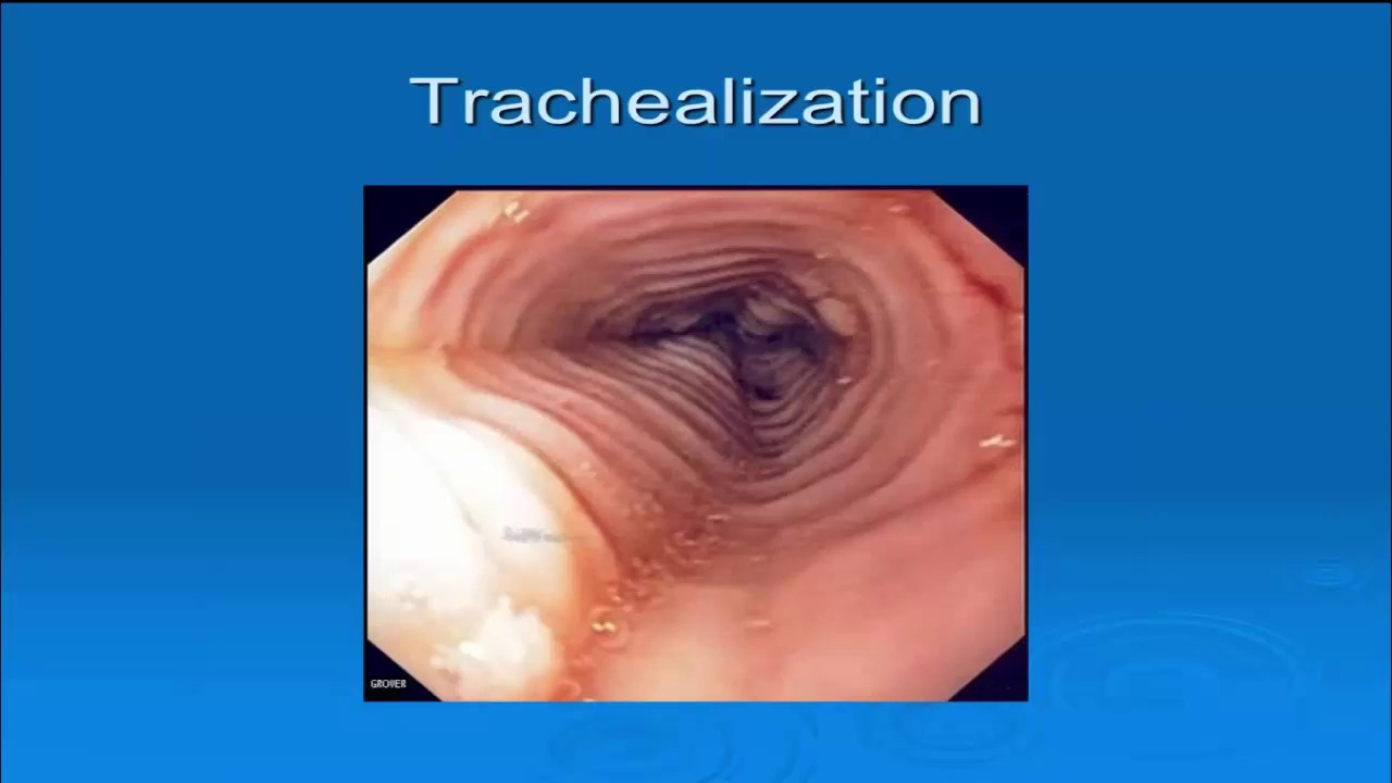 Eosinophilic Esophagitis (Page) - YouTube