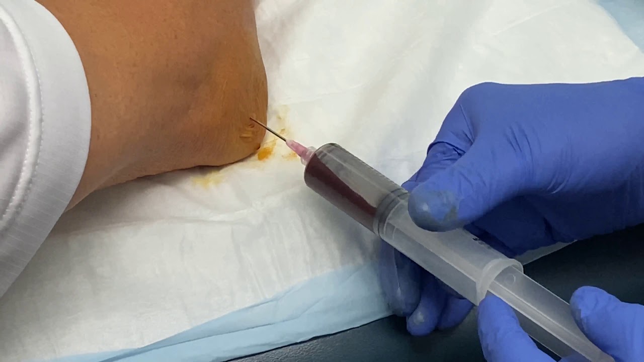 MoraMD: Draining Elbow Bursitis. It’s not that bad. - YouTube