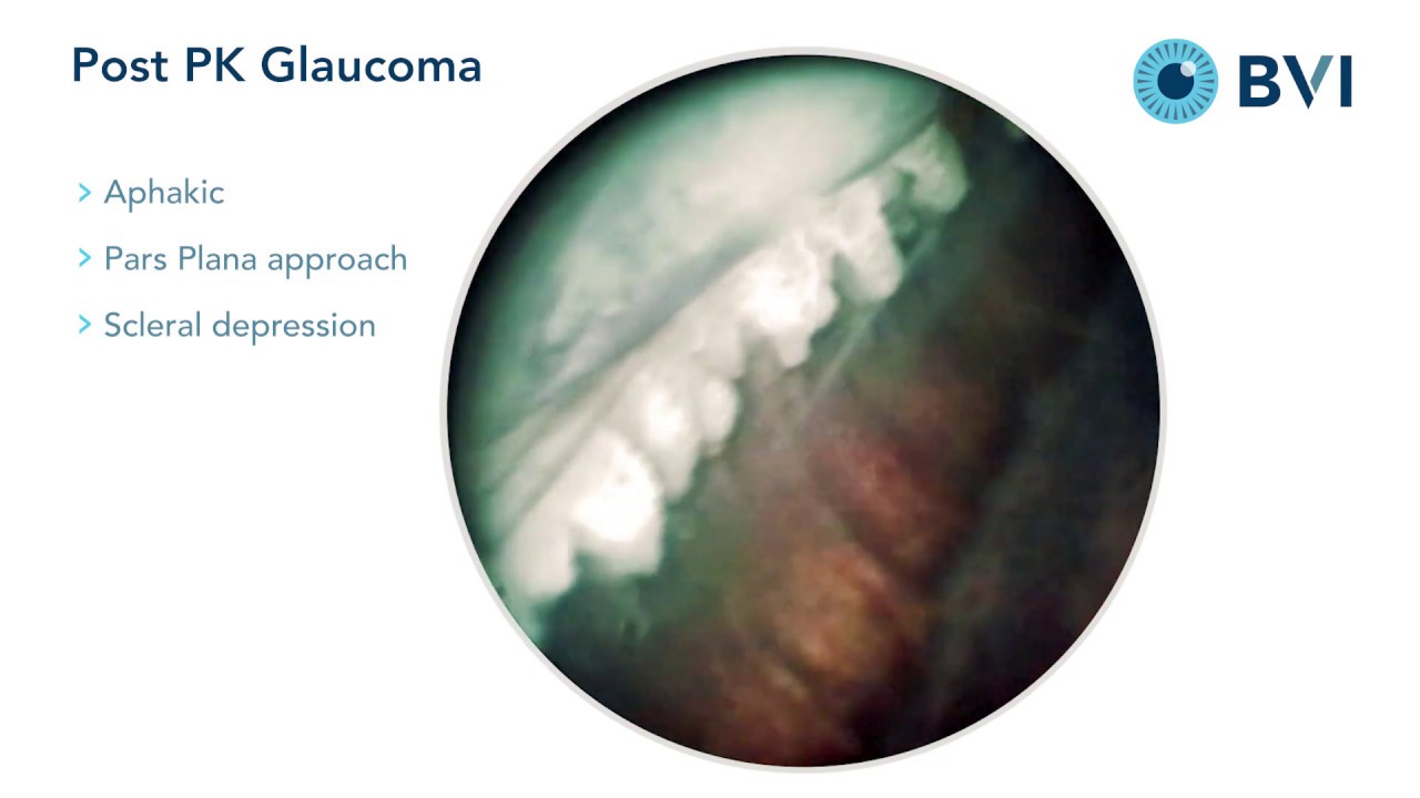 ECP - Post PK Glaucoma - YouTube