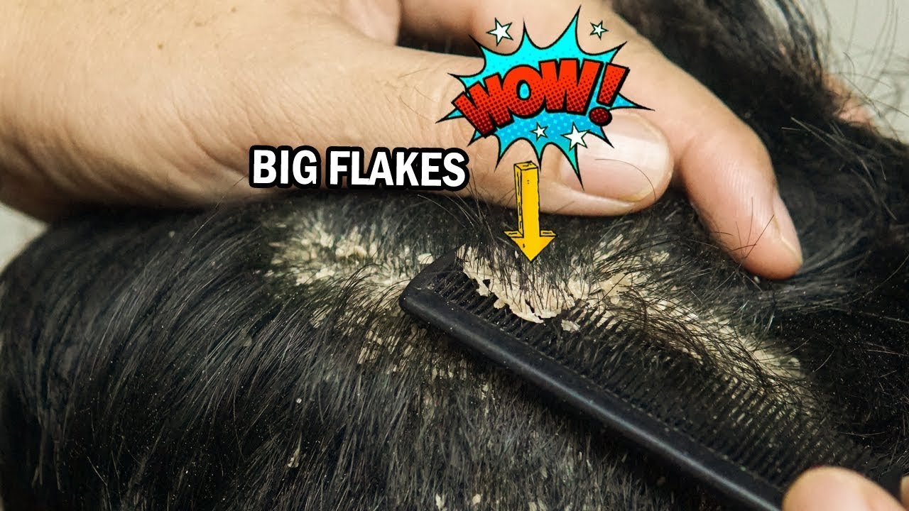 Dandruff Big Flakes Scratching Satisfying Itchy Dry Scalp - YouTube