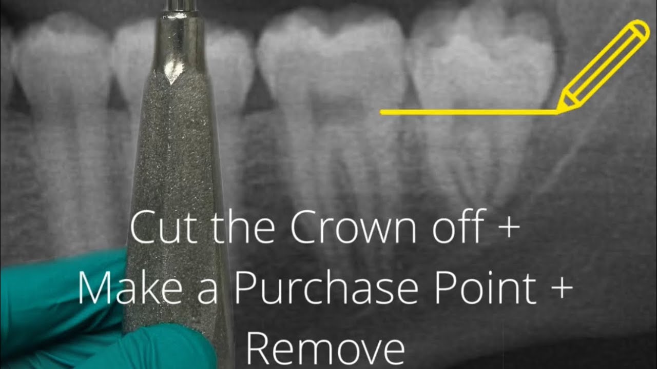 Cut the Crown off to Remove this Wisdom Tooth - YouTube