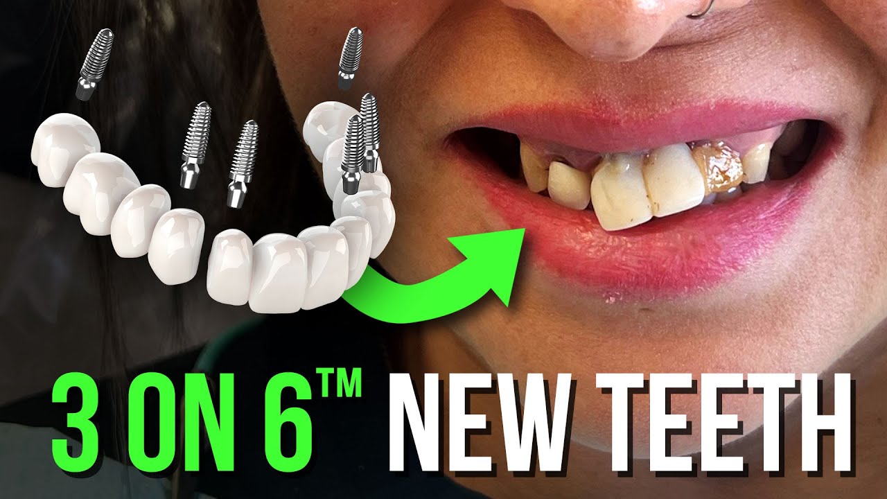 Monica's Life-Changing 3 on 6 Dental Transformation Journey | From ...