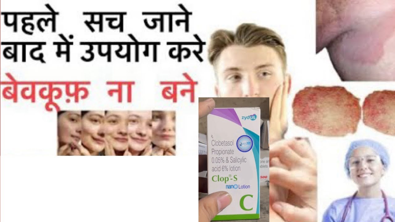 Clop S lotion Full Information In Hindi | Uses | Side effects | Dosage ...