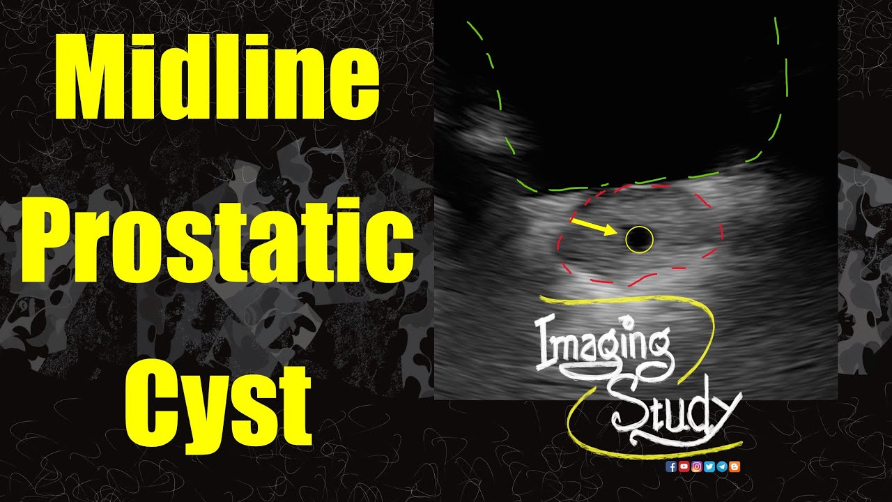 Midline Prostatic Cyst || Ultrasound || Case 349 - YouTube