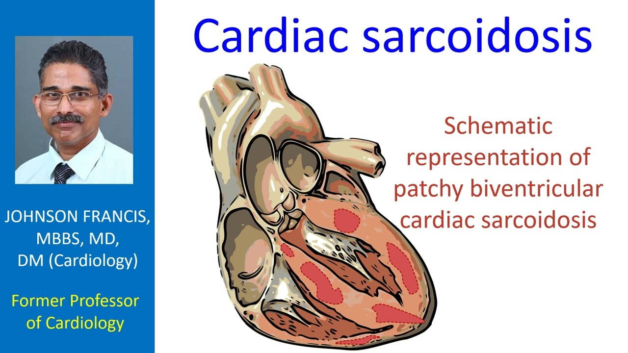 Cardiac sarcoidosis - YouTube