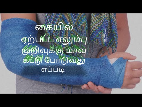 How to apply The Above elbow plaster(cast)in fracture involing forearm ...
