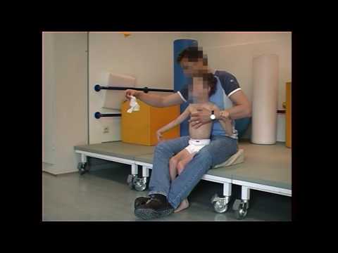 Dyskinetic cerebral palsy, case 2