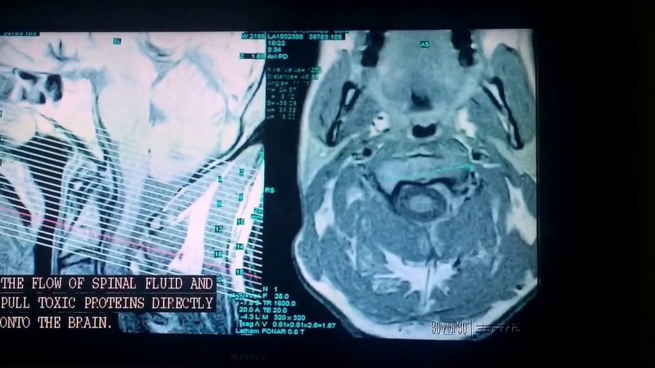 Spinal fluid blockage - YouTube
