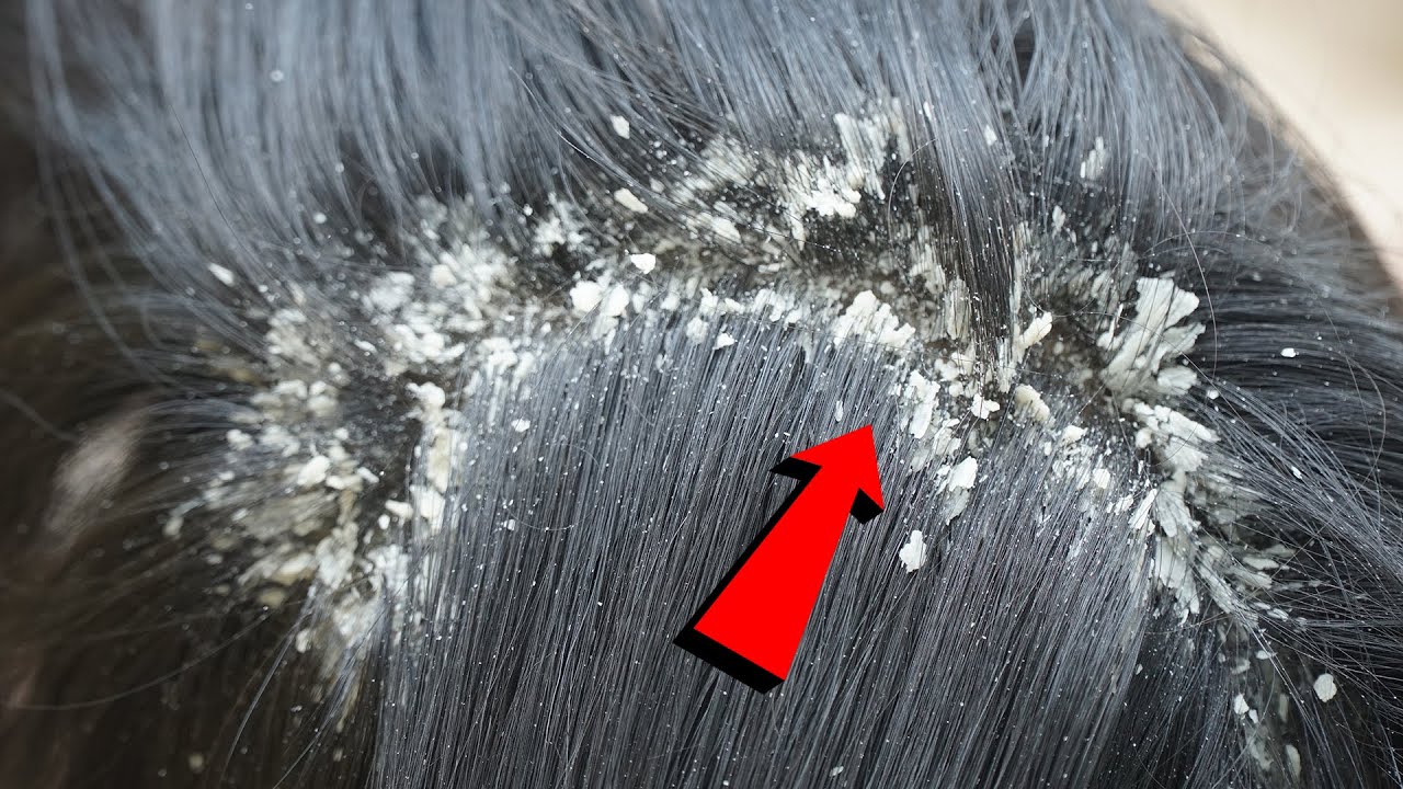 Hair Combing Dandruff / Cialina Channel 1140 - YouTube