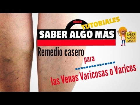 Como eliminar las varices en casa de forma natural - Remedio casero ...