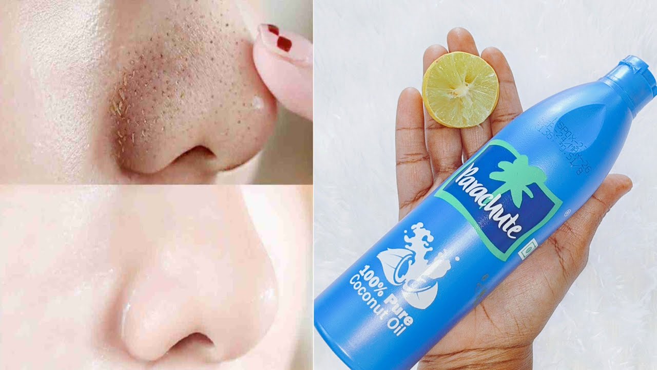 How to remove blackheads on nose naturally at home with coconut oil ...