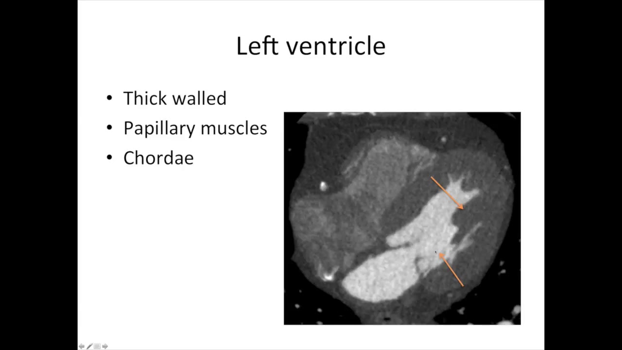 Cardiac anatomy for radiology - Part 1 - cardiac chambers - YouTube