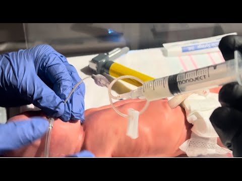 Less Invasive Surfactant Administration (LISA)@McGlinnInstituteNeonatal ...