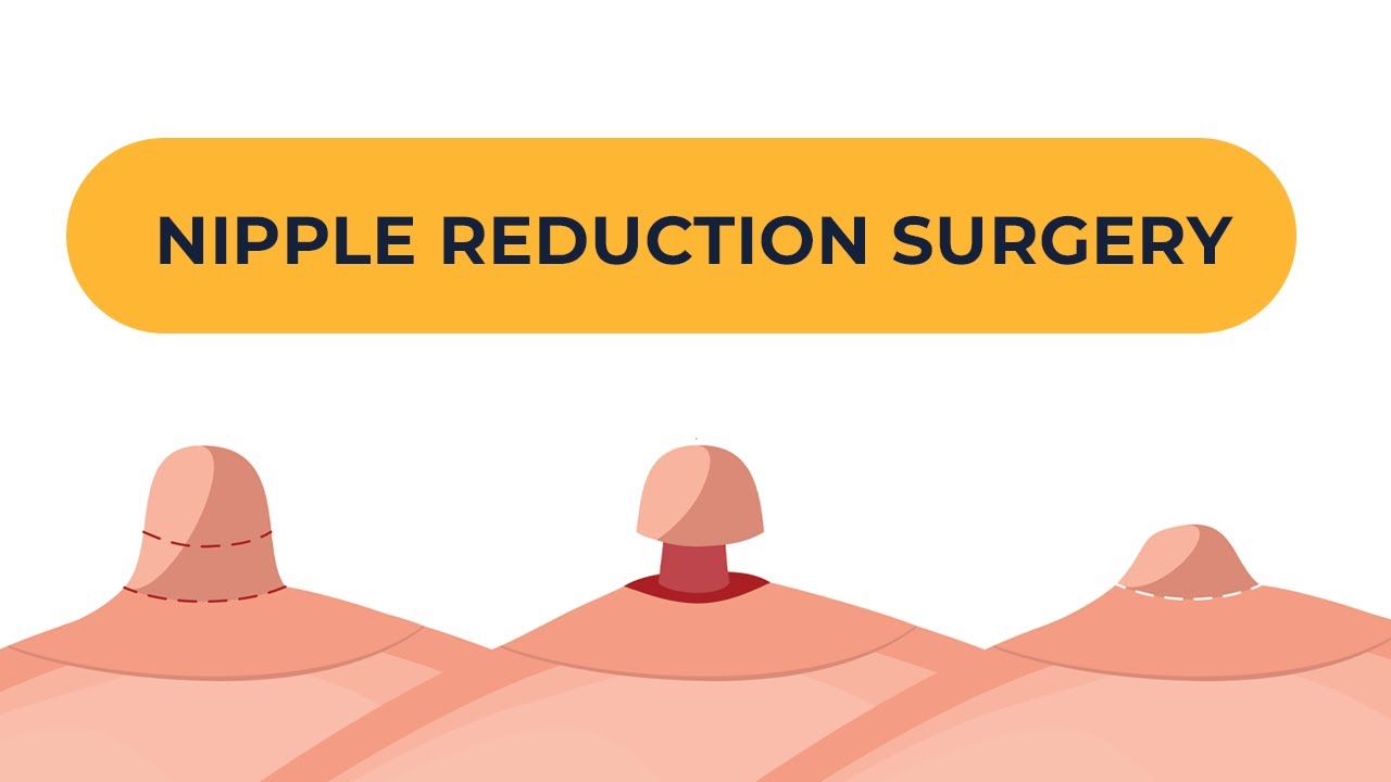 who-should-consider-nipple-reduction-nipple-reduction-surgery-in