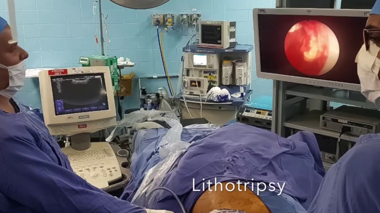 Ultrasound guided (fluoroscopic-less) standard PCNL (26Fr). - YouTube