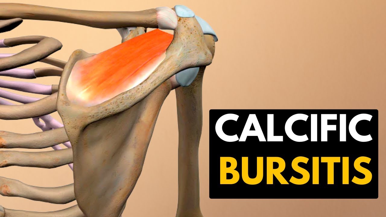 Calcific Bursitis, Causes, Signs and Symptoms, Diagnosis and Treatment ...