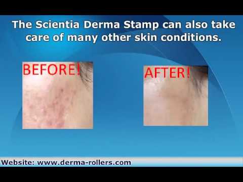 Derma Stamp for Acne Scars - YouTube