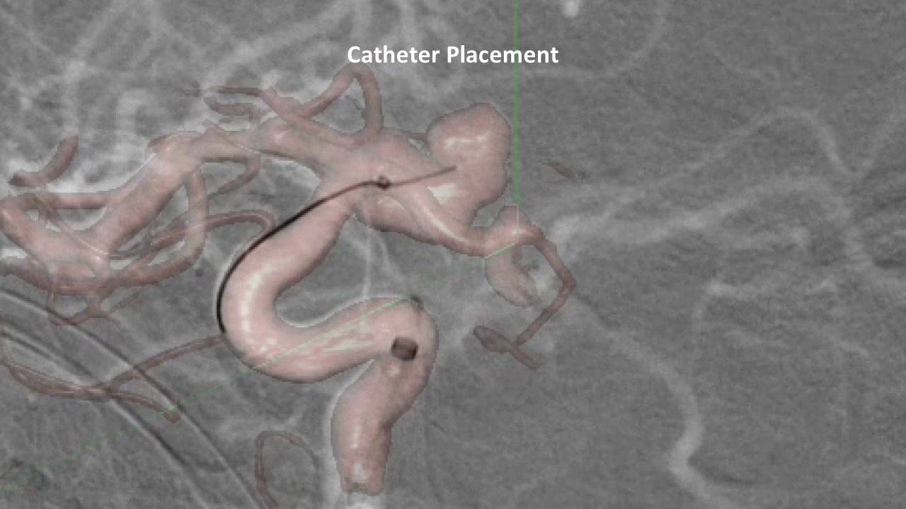 WEB Treatment of 7 mm Ruptured PCOM (Fusiform) Aneurysm - YouTube