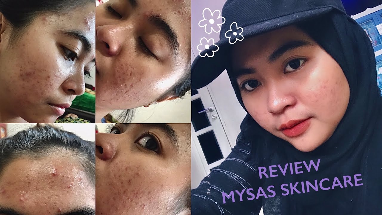 REVIEW Produk MYSAS SKINCARE | Acne SkinCare | SkinCare Jerawat | Obat ...