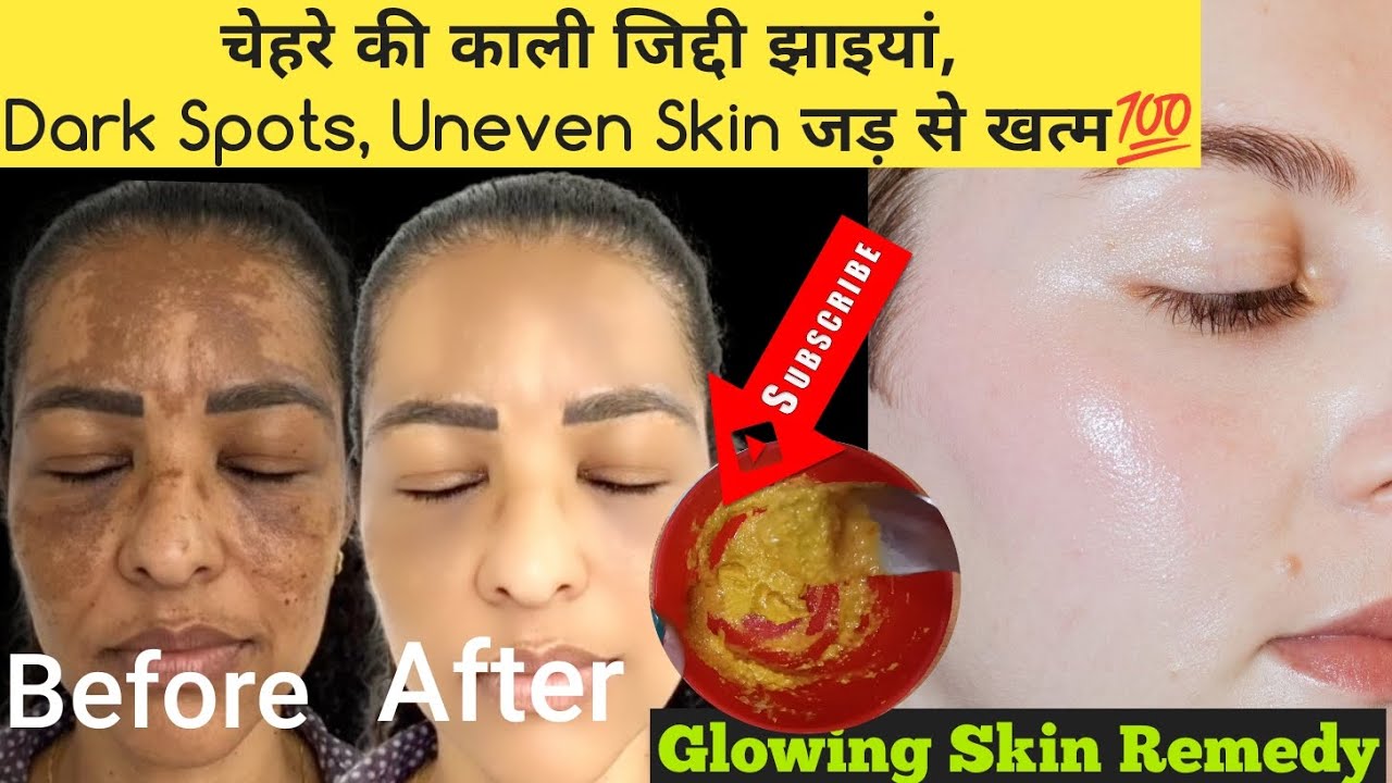 Skin Transformation Get Glowing, Flawless Skin . Get Rid Pigmentation ...