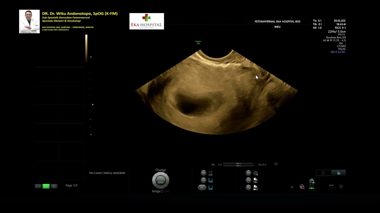 KEHAMILAN 9 MINGGU NORMAL (Dr Wiku Andonotopo) - YouTube